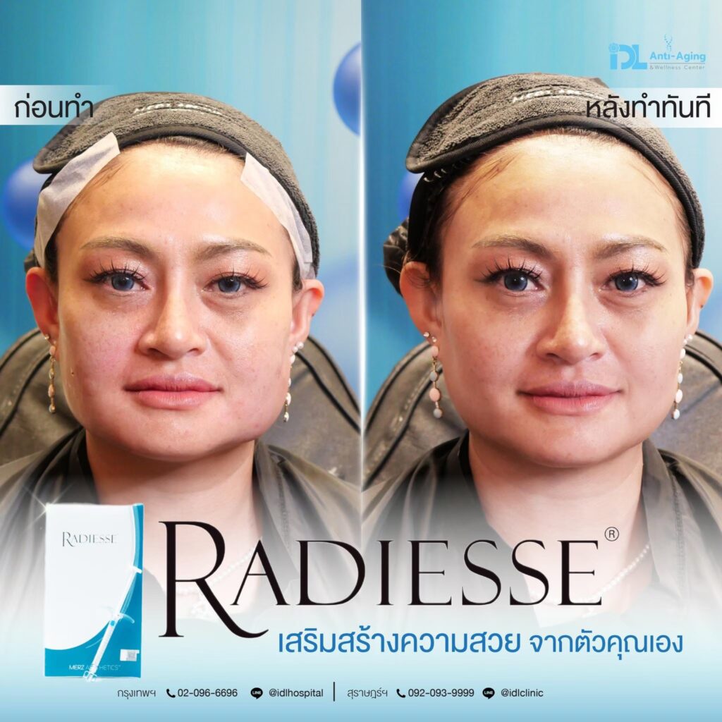 โปรแกรมหน้าใส - IDL HOSPITAL